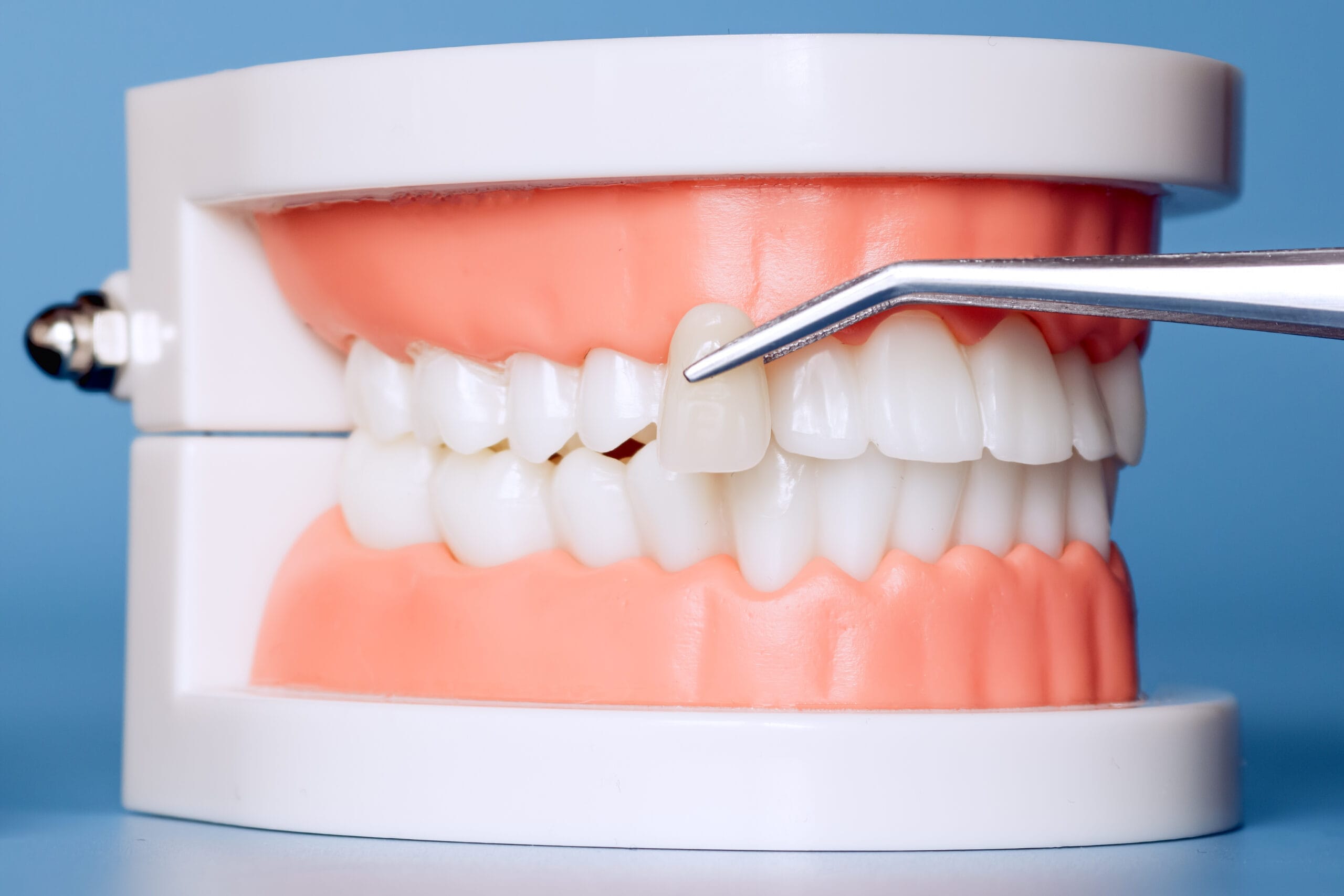 What to Expect During the Veneer Procedure? | Slipacoff Dental Centre
